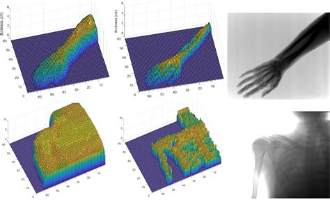 A Multiscale Optimisation Algorithm For Shape And Material Reconstruction From A Single X Ray Image