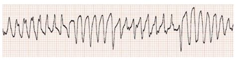 Catecholaminergic Polymorphic Ventricular Tachycardia Novel