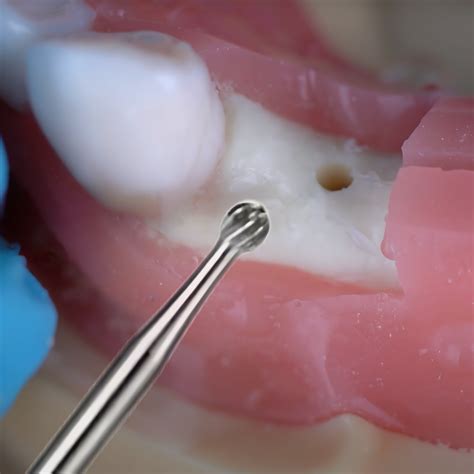 9 Amazing Applications Of Bone Cutting Burs In Dentistry Mr Bur