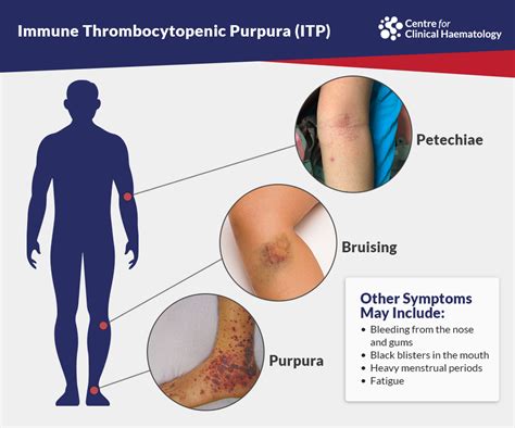 Immune Thrombocytopenia Cfch Centre For Clinical Haematology