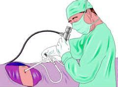 Thoracoscopy Endoscopy Pleural Pleural Endoscopy Pleuroscopy