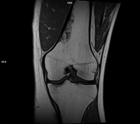 Caz Nr 53 Lipom Intraosos Ghid Radiologie