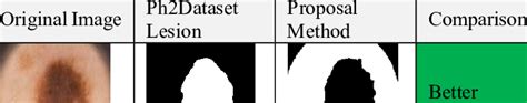 Comparison Between Segmented Lesion From Ph2 Dataset And Proposal
