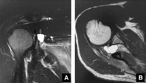 Figure 1 From Arthroscopic Decompression Of Spinoglenoid Notch Cyst And Slap Repair Through A