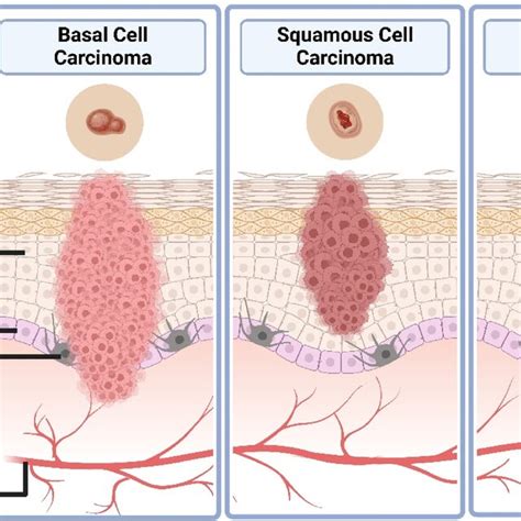 Schematic Representation Of Utilization Of Nanoparticles In Skin Cancer