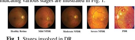 Figure 1 From Automated Detection And Classification Of Fundus Diabetic Retinopathy Images Using
