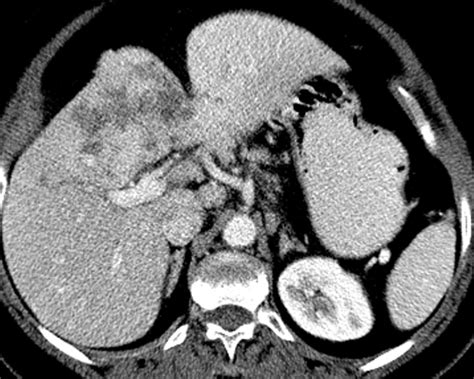 Liver Atlas Diagnosis Eosinophilic Cholangitis