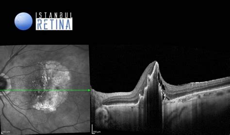 67 Retinal Pigment Epithelium Tear Oct Club