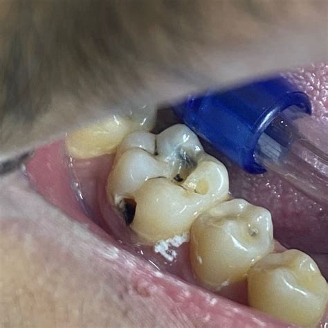 Rayan Aldakhil On Linkedin Saving The Tooth Life Of Badly Decayed