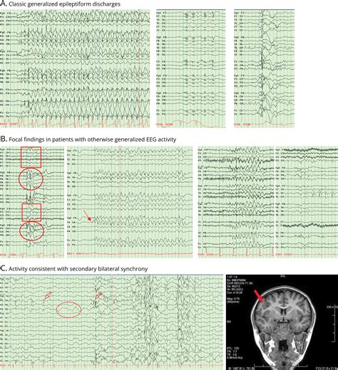 Idiopathic Generalized Epilepsy Neurology
