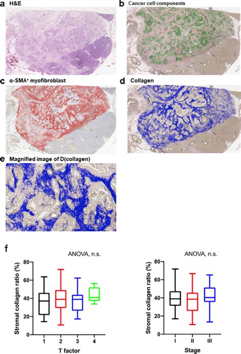 A Comprehensive Analysis Of Tumor Stromal Collagen In Relation To Pathological Molecular And