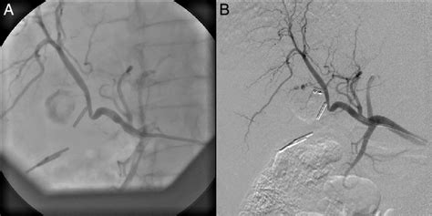 A Angiography Image Demonstrating The Pseudoaneurysm B