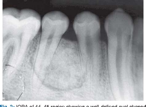 Osteoid Osteoma Imaging Overview Radiography Computed