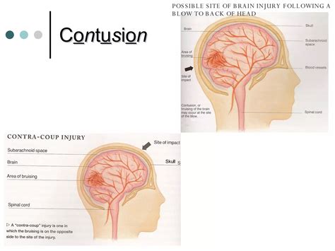 Head Injuries And Concussion Ppt