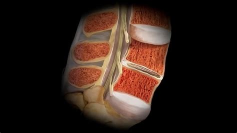 Real Intervertebral Disc Validity And Interobserver Agreement Of A New