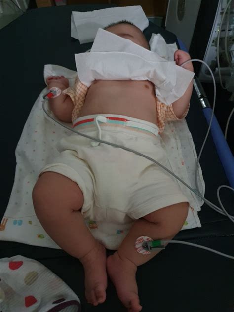 아기심장잡음 심장초음파검사2번꼬리뼈함몰다지증음경짧음설소대짧음소변줄가느다람 네이버 블로그