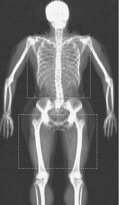 Dxa Image Showing Defined Regions Of Interest In Calculating The Download Scientific Diagram