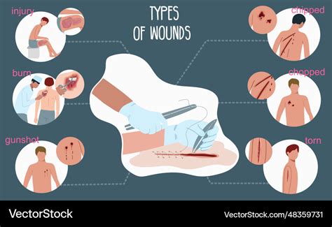 Types Of Wounds Infographics Royalty Free Vector Image