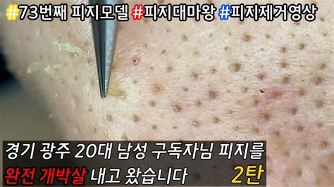피지 직접 뽑아드렸습니다 피지제거 블랙헤드제거 피지뽑기 경기 광주시에 사는 20대 남자구독자님의 쫀쫀한 피지 정복 프로젝트 2탄 Youtube