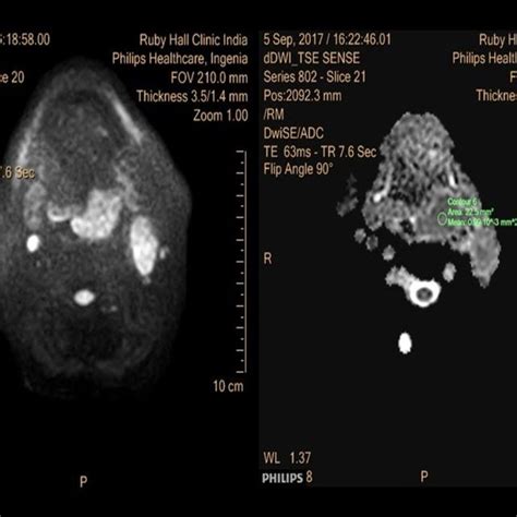 A Diffusion Restriction Present On Diffusion Weighted Images B 600 Download Scientific
