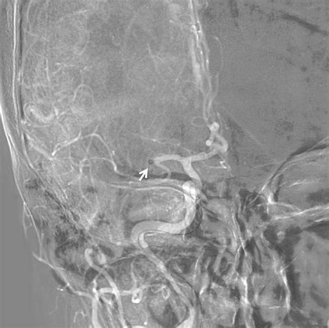 Digital Subtraction Angiography Dsa Roadmap Images During Download Scientific Diagram