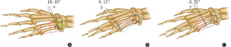A B And C Show That The Hamate Surface And The Fifth Metacarpal