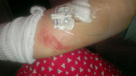 Melissa S Lyme Life PICC Line Problems