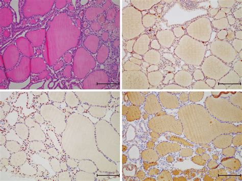 Microphotograph Of Thyroid Ectopia In The Nodules In Her Bilateral Lung