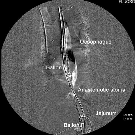 New Gastrointestinal Decompression Tube Download Scientific Diagram