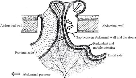 Stoma Prolapse Definition At Norma Cuellar Blog
