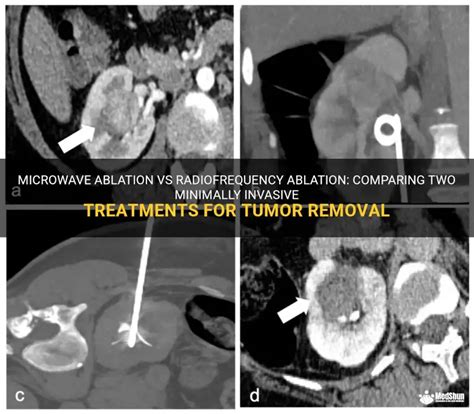 Microwave Ablation Vs Radiofrequency Ablation Comparing Two Minimally Invasive Treatments For