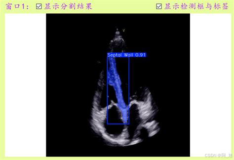 基于yolo11深度学习的心脏超声图像间隔壁检测分割与分析系统【python源码pyqt5界面数据集训练代码】深度学习实战、目标分割