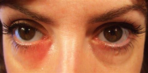 Rash Around Eyes Causes Treatment And Pictures