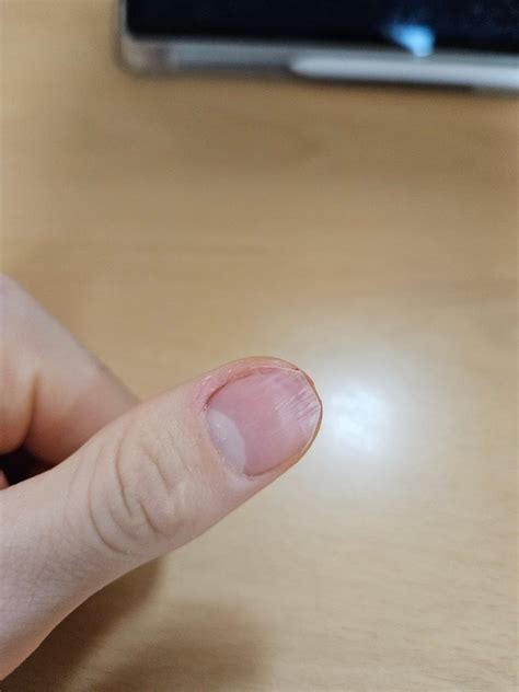 손톱이 꺾여서 피가나요 지식in