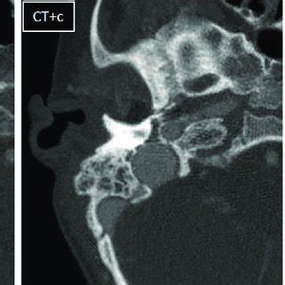 Acute Coalescent Mastoiditis In A Six Year Old Boy Ct With Iv