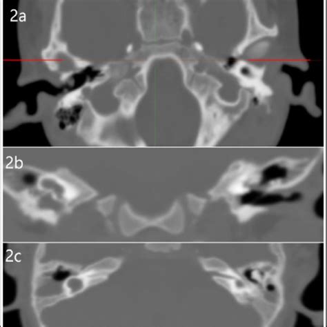 The Average Age At Surgery In The Ossicular Chain Fixation Of And Download Scientific Diagram