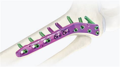 ORTHOMEDIC INNOVATIONS Internationally Active Medical Technology Company