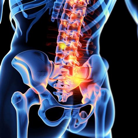 Facet Joint Injuries And Chiropractic