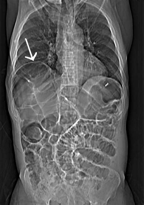 Pseudo Obstruction Colonic Acute Colonic Pseudo Obstruction Ogilvie