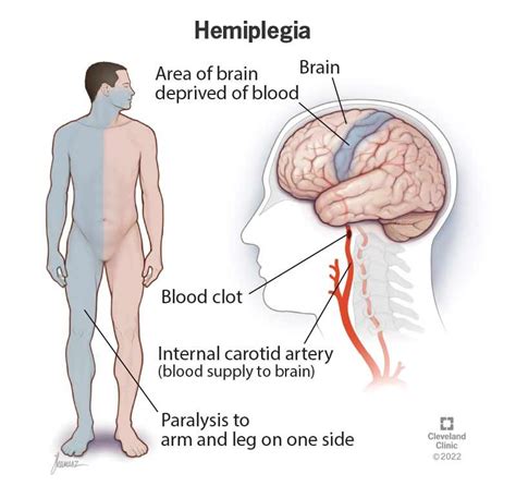 Occupational Therapy Vs Physical Therapy For Stroke Recovery Whats