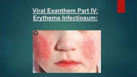 Viral Exanthems