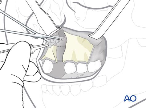 Alveolar Bone Grafting For Unilateral Cleft Lip Andor Palate