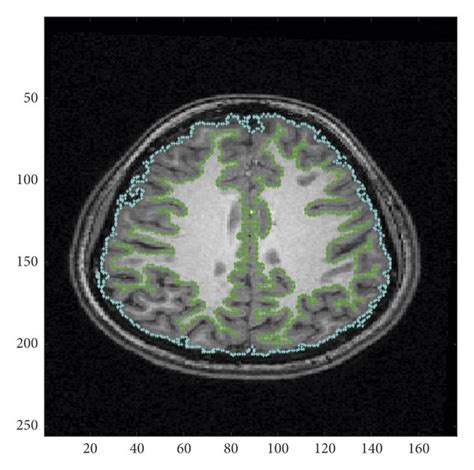 Segmented White Matter Green Boundary And Gray Matter Blue