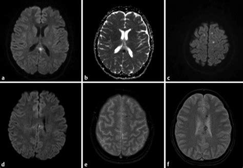 Brain Edema Pathophysiology Radiology Key