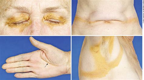 Plane Xanthoma