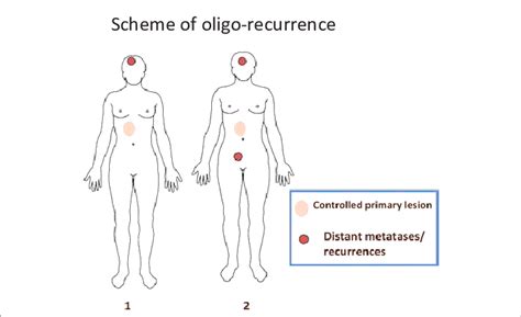 Scheme 1 Shows One Distant Metastasis With A Primary Lesion Scheme 2