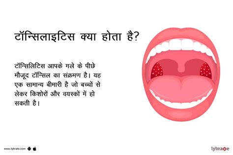 टोंसिल टोंसिलिटिस के लक्षण कारण इलाज दवा उपचार और परहेज Tonsils