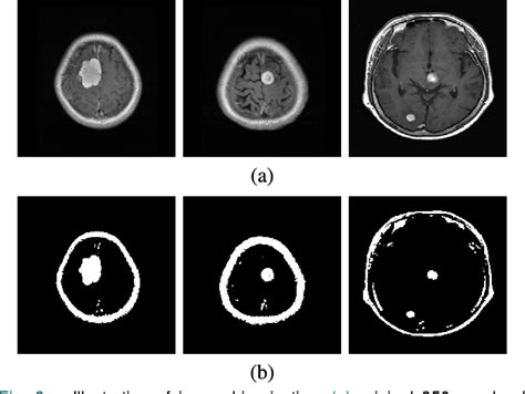 Figure 2 From Novel Robust Automatic Brain Tumor Detection And
