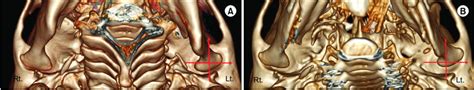 Bilateral Sagittal Split Ramus Osteotomy Bssro With Bony Interference
