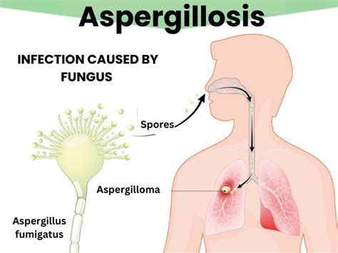 What Is Aspergillosis Know About Harmful Impact Of This Disease On